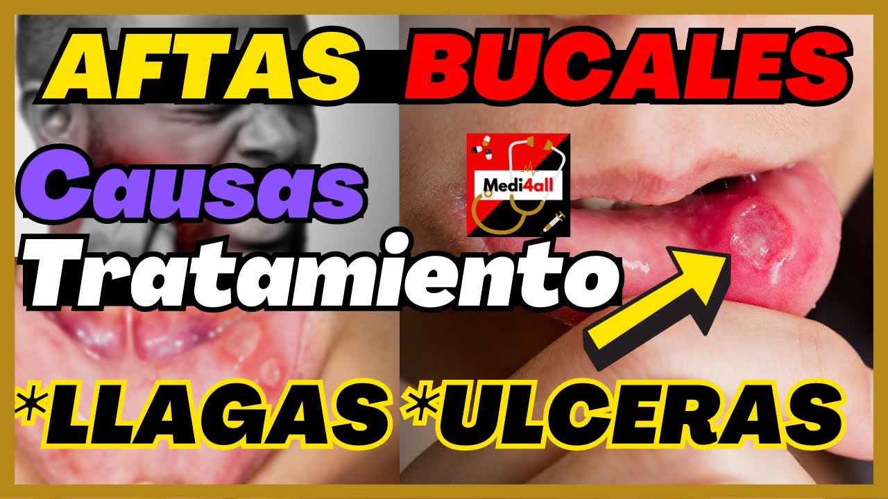 Guía para identificar y tratar aftas bucales